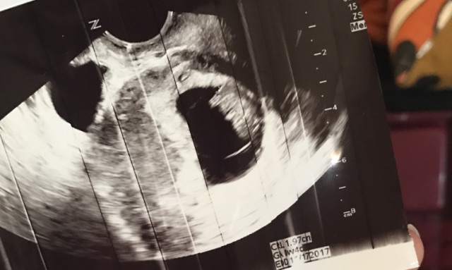 what is this BLACK SPOT on sonogram?! - Glow Community
