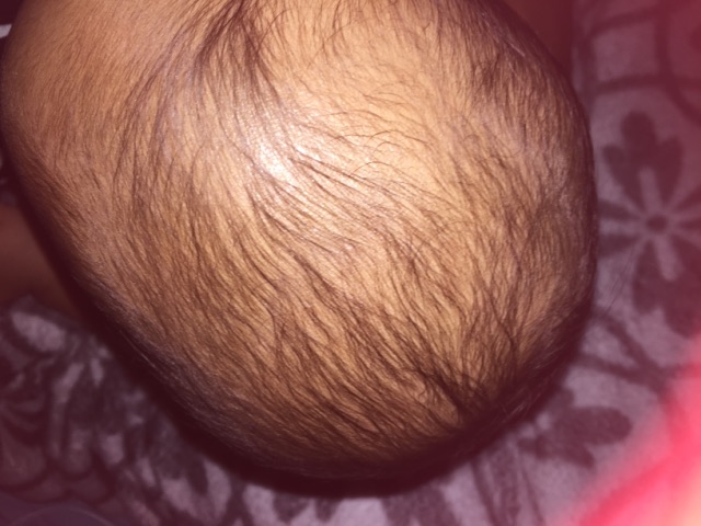 Is it normal? My 6 month old daughter soft spot is bulging - Glow Community