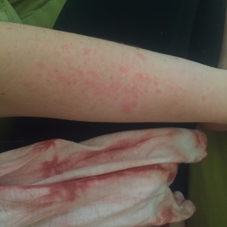 Any ideas on what this rash could be?? Just started Flonase Sensimist 3 ...
