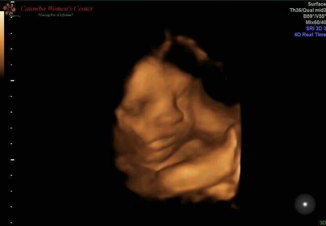 Our 3D Ultrasound @26 weeks 4 days - Glow Community