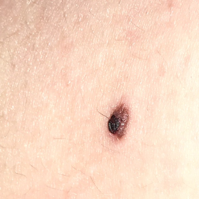 So I found this mole today. Its around my waistline area and would ...