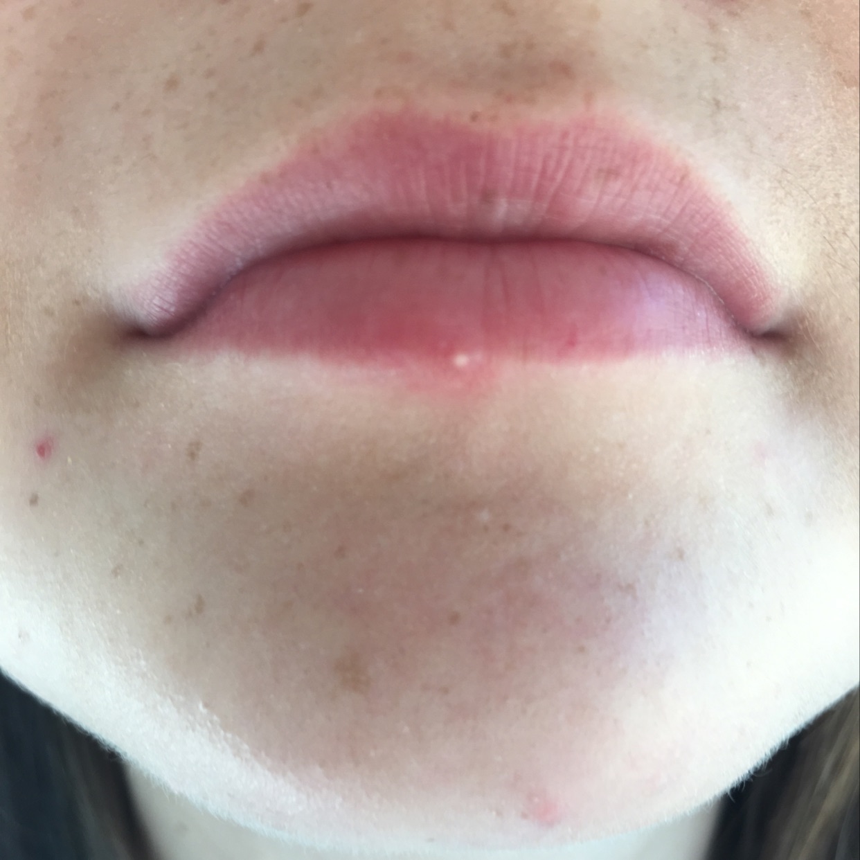 Okay. So this may be weird. But I have this bump on my bottom lip. It ...