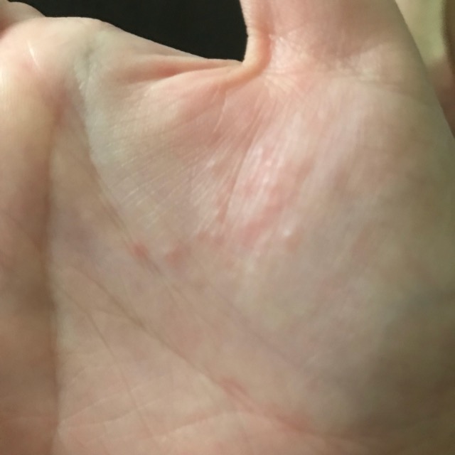 Bumps on the palm of hand.. what can it be? - Glow Community