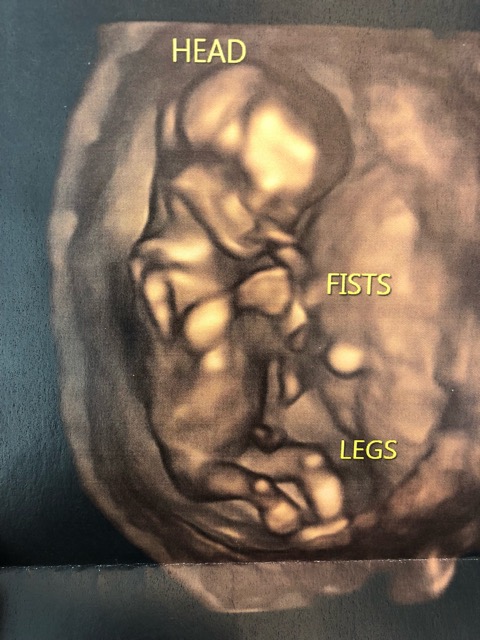 12 Week 3d Ultrasound Boy