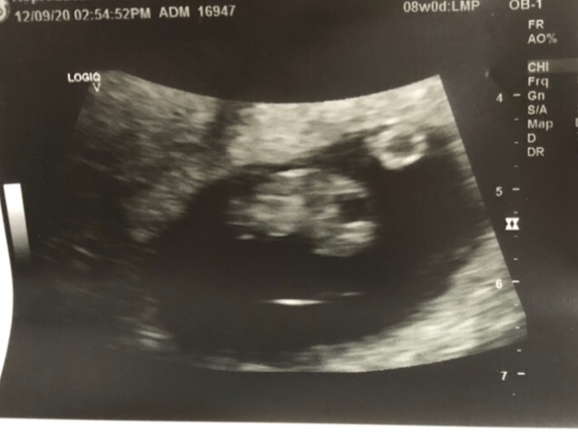 Empty gestational sac success story - Glow Community