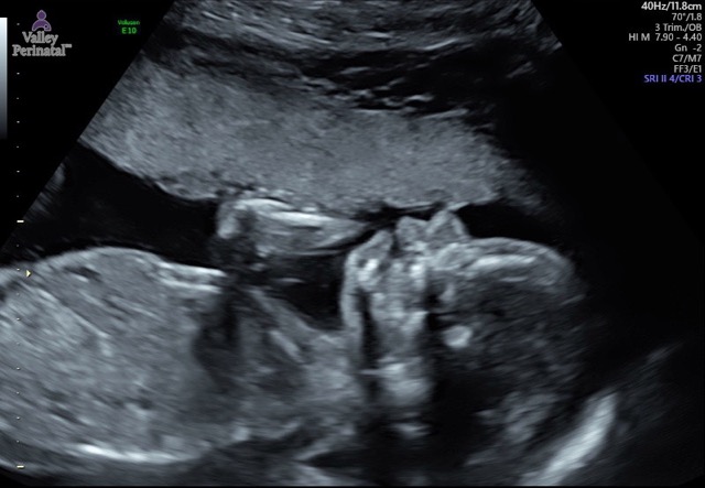 20 week anatomy scan - Glow Community