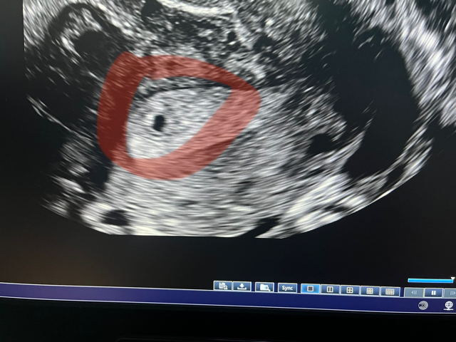 5 week ultrasound - Glow Community