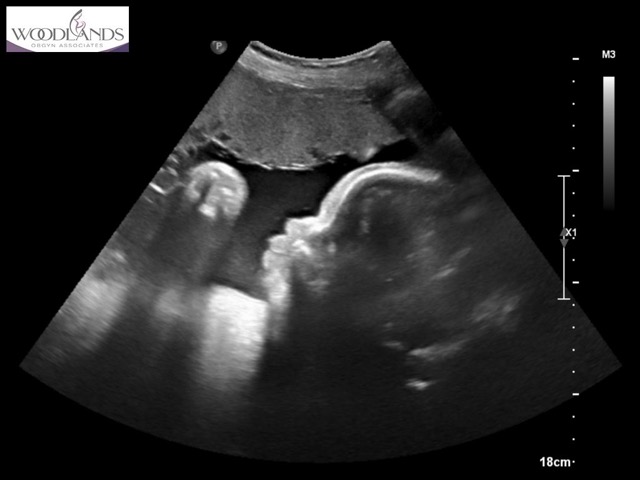 Ultrasound and the baby had eyes open! - Glow Community