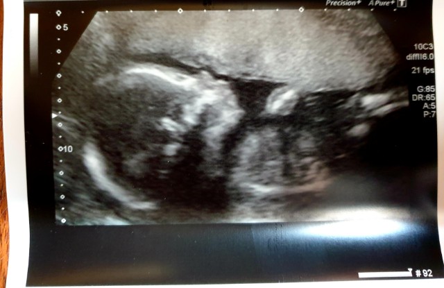 20 week scan 🥰 - Glow Community