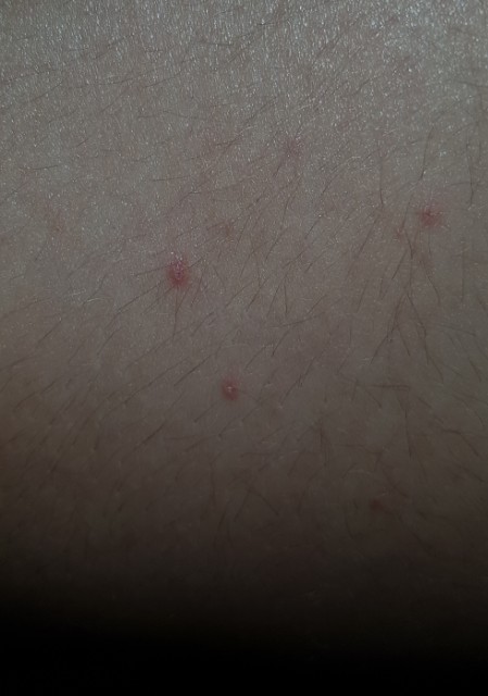 Is this shingles? 29 weeks pregnant - Glow Community