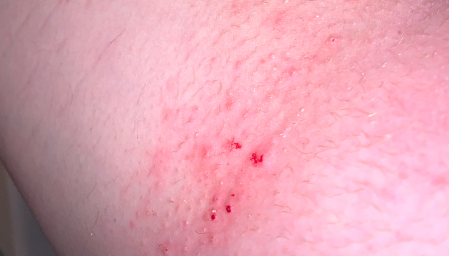 TMI! Bikini line razor burn/bumps/rash - Glow Community