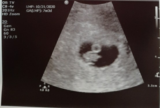 7 weeks + 4 days ultrasound - Glow Community