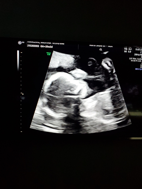 20 week anatomy scan! - Glow Community