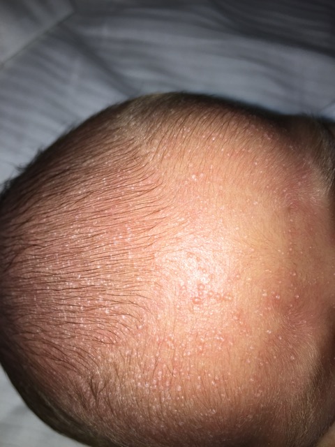 What is this rash on my newborns head ? - Glow Community