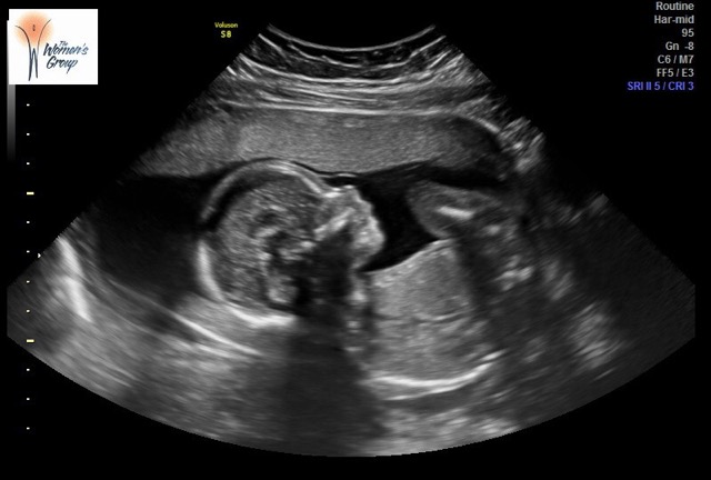 20 week anatomy scan - Glow Community