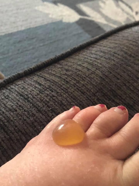 Sepsis? Spider bite? Really worried... - Glow Community