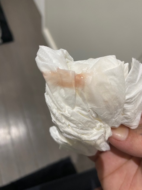 Depo, TTC, confused, implantation bleeding? - Glow Community