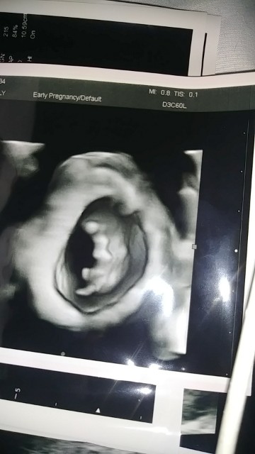 9 Week Ultrasound 3d