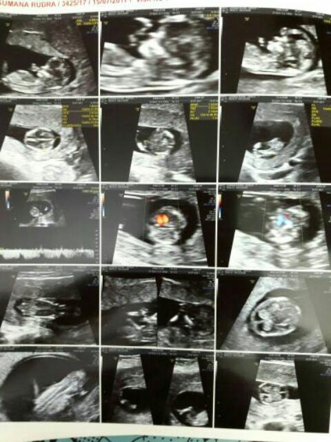 1st trimester screening test... boy or girl? what to expect? - Glow ...