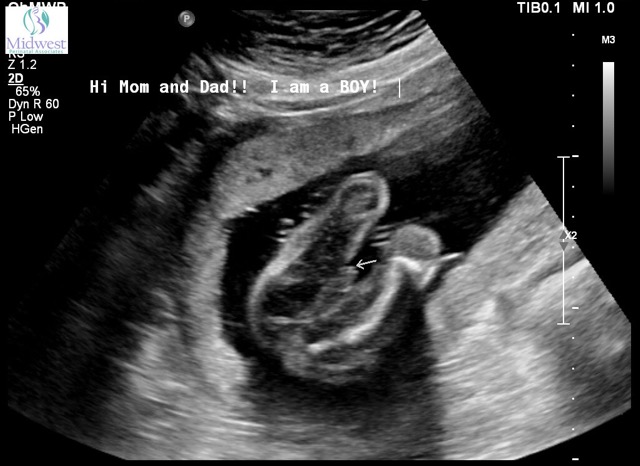 Anatomy Scan 21 weeks 4days - Glow Community