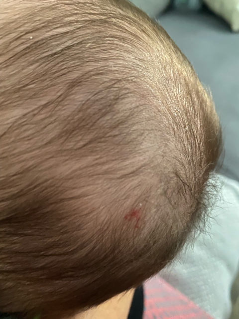 What is that red spot on my 2 month old baby? - Glow Community