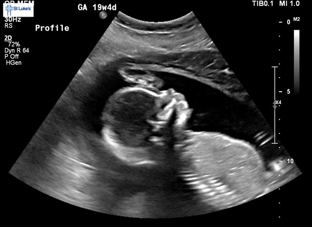 19 weeks and 4 days ultrasound! - Glow Community