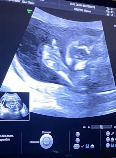 18 week scan, having a baby boy 🥰 - Glow Community