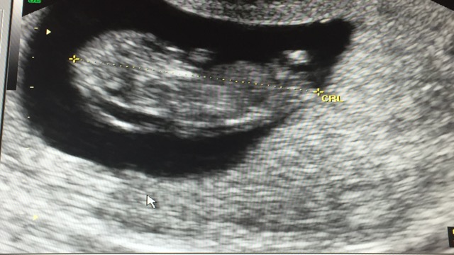 Nuchal fold 9 weeks - Glow Community