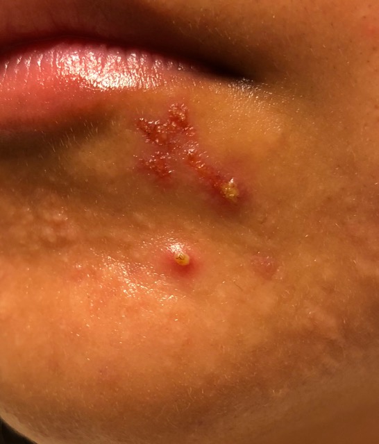 Herpes? Rash? Idk?? **Updated - Glow Community