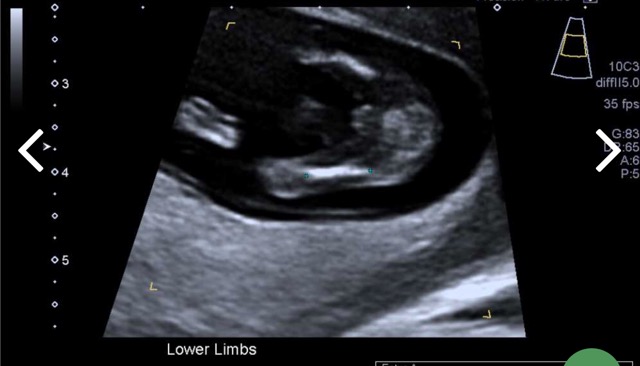 Boy or girl? 12 week scan - Glow Community