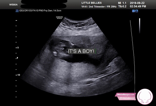 How accurate is 16 week gender scan - Glow Community