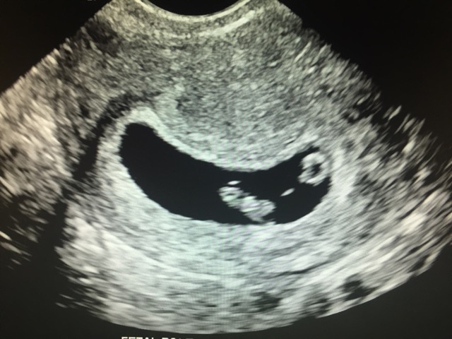 First Ultrasound Photo - Glow Community