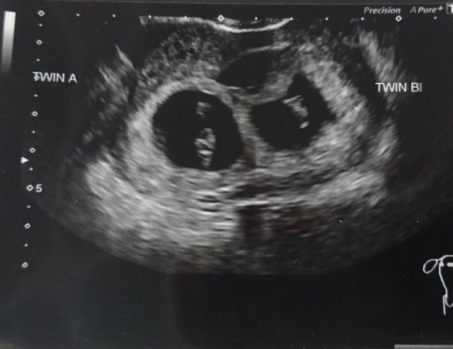 Early scan after spotting! TWINS! - Glow Community
