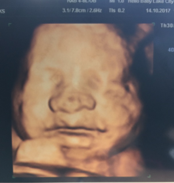 28 weeks 3D/4D ultrasound!!💕 - Glow Community