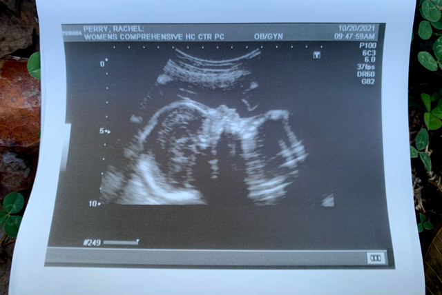 Had our anatomy scan done today; currently 22 weeks with our girl💕😍 ...