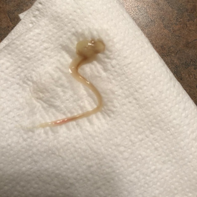 Mucous plug or just normal discharge - Glow Community