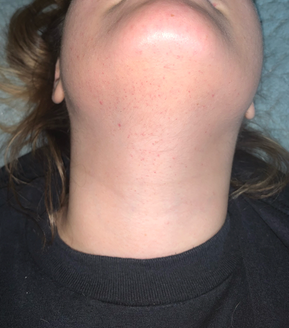 Puked so hard I popped blood vessels! - Glow Community