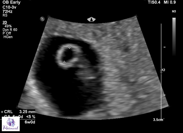 Ultrasound at 6w5d. Transvaginal- boy or girl Ramzi guesses? - Glow Community