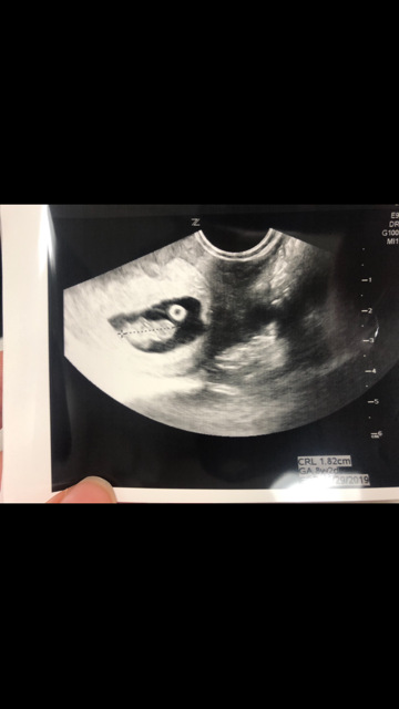 8 Week Ultrasound - Placenta? - Glow Community