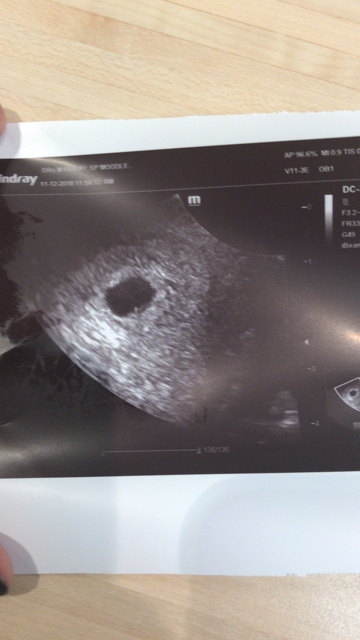 5 weeks and 4 days sac but no baby? - Glow Community