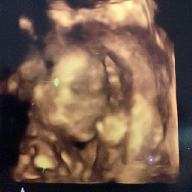 20 Week Anatomy Scan Glow Community