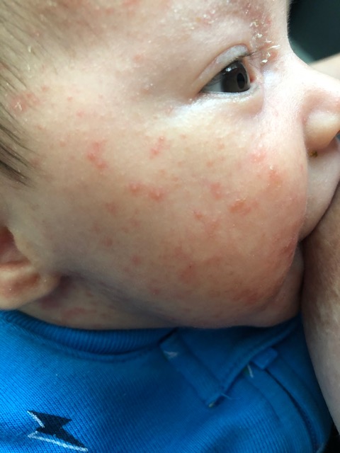 Rash on baby’s face, head and neck 😣 - Glow Community