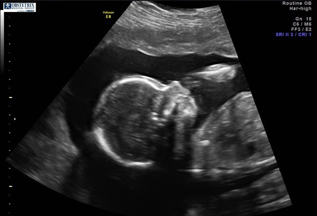 18 week anatomy scan - Glow Community