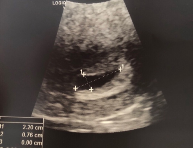 Empty gestational sac success story - Glow Community