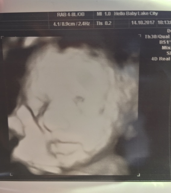 28 weeks 3D/4D ultrasound!!💕 - Glow Community