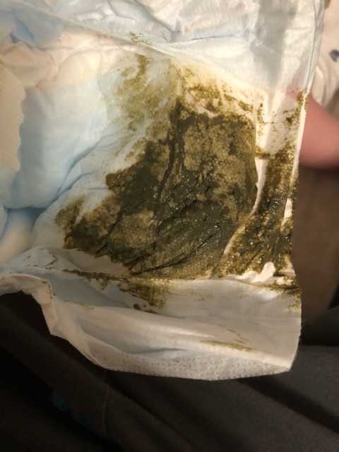 This pic is TMI! Baby poop! Should I switch formulas? - Glow Community