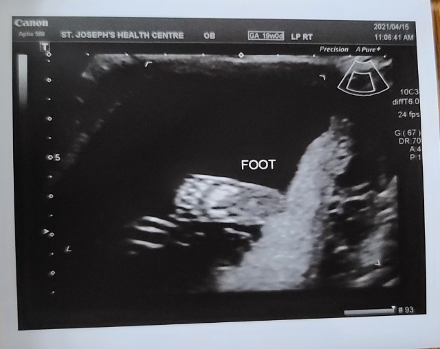 19 week anatomy scan - Glow Community