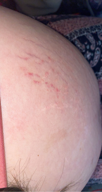 Burning Red Dots On Stomach Glow Community burning-red-dots-on-stomach-glow-community