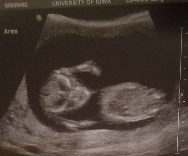 13 week scan boy or girl? - Glow Community