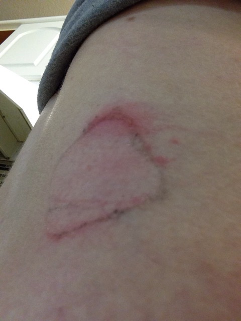 Birth control patch reaction - Glow Community